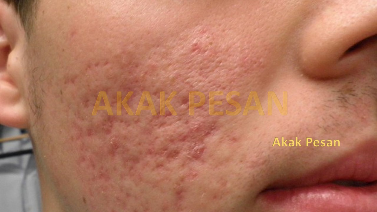 Tanggalkan Parut Jerawat Dengan 10 Cara Mudah Dan Cepat - Akak Pesan